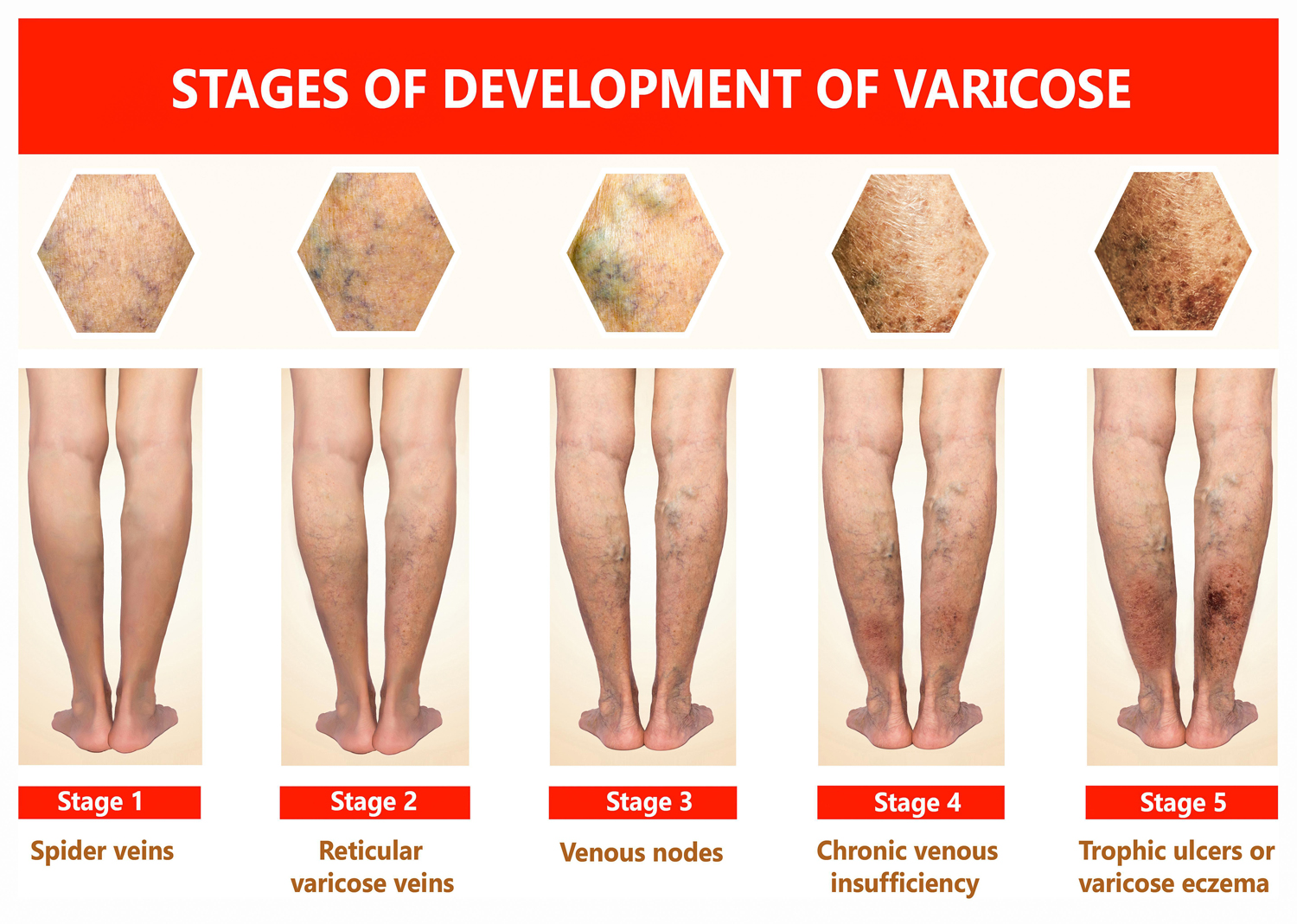 Spider Veins Imaging And Interventional Specialists